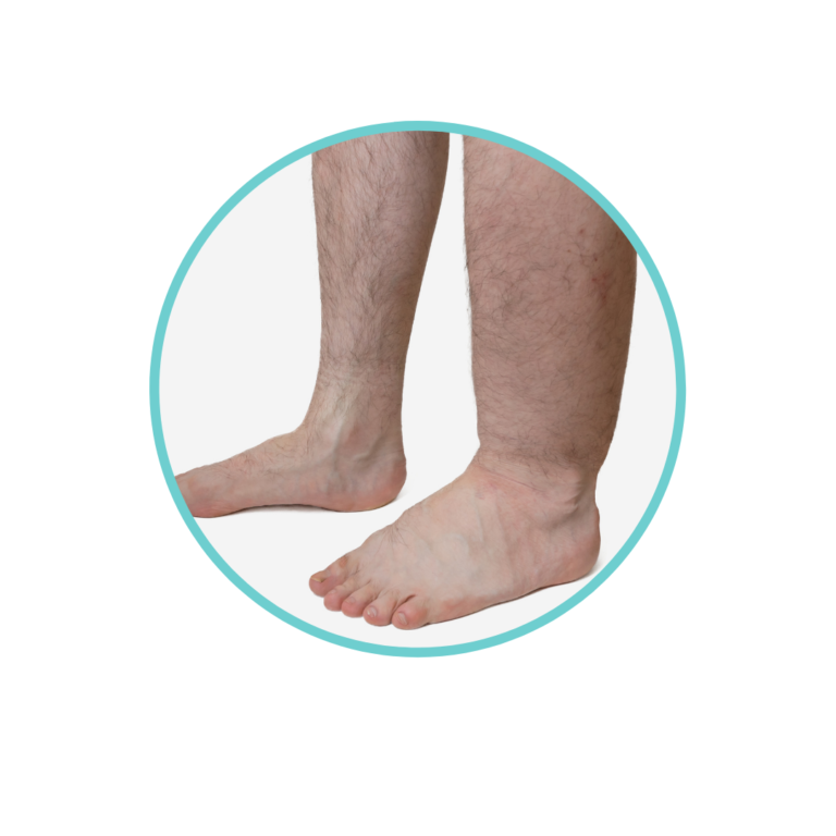 ¿Qué es un edema? ¿Qué tipo de edemas existen? - MMC CLINIC CENTER