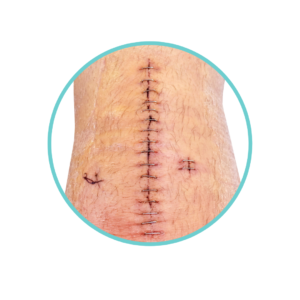 ¿Qué es un edema? ¿Qué tipo de edemas existen? - MMC CLINIC CENTER