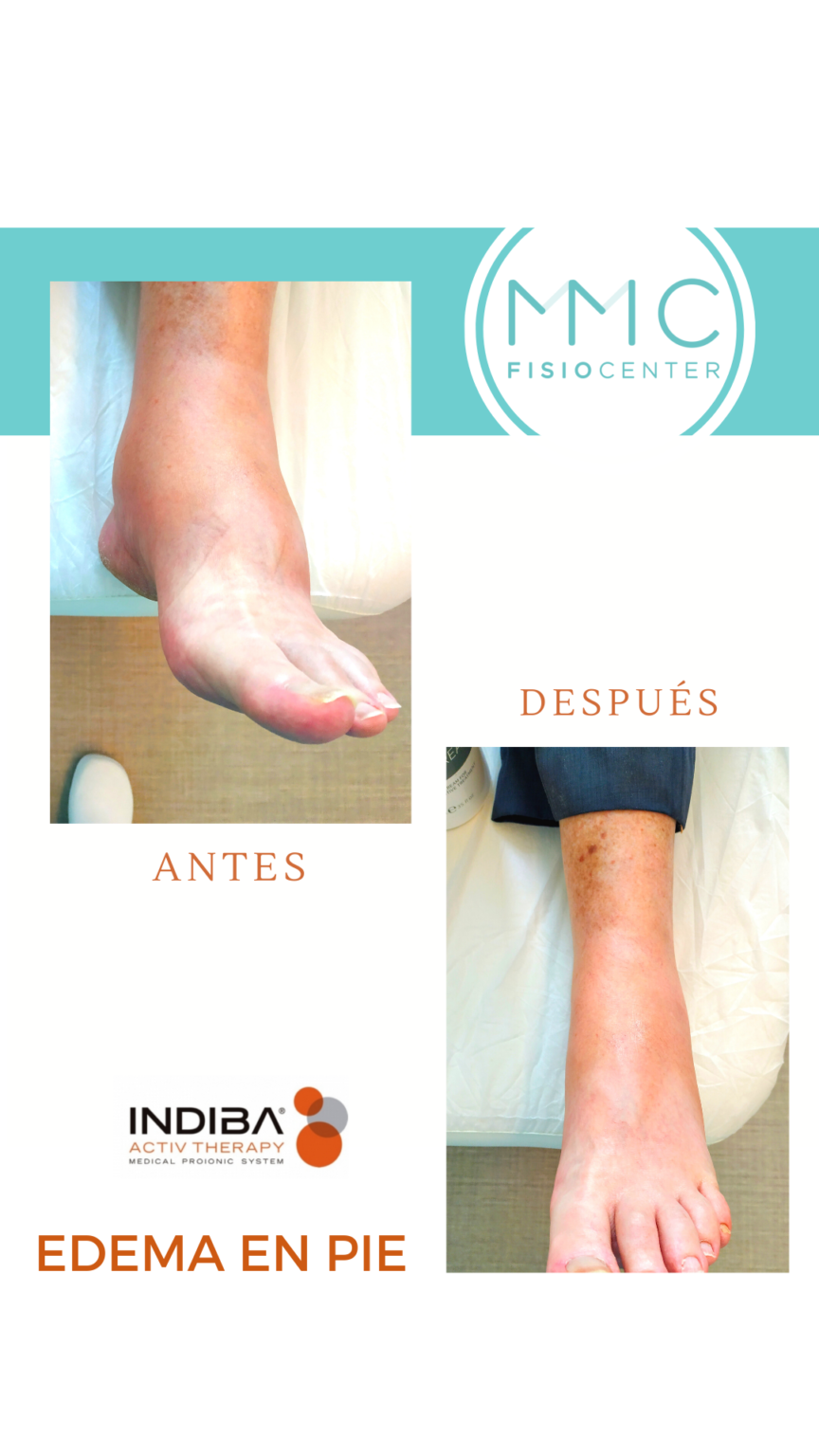 ¿Cómo evaluamos si es un edema? | MMC CLINIC CENTER